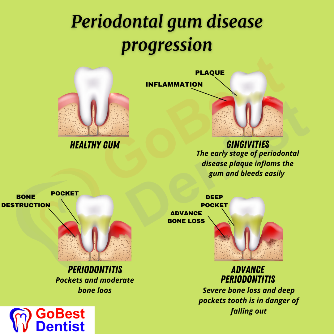 Types Of Dental Flap Surgery Infoupdate Types Of Dental Flap Surgery Infoupdate